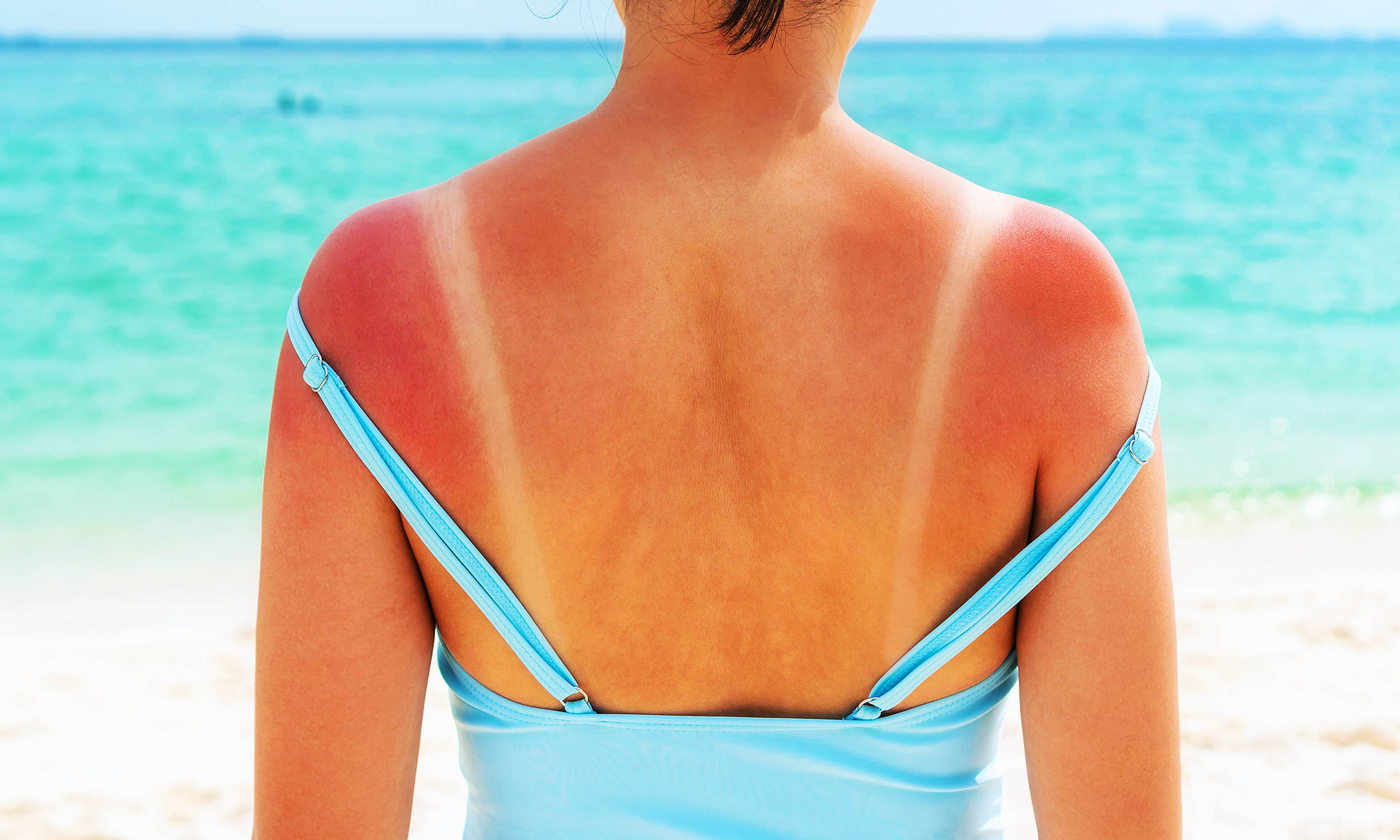 Main cause of sunburn is identified, it's time to rewrite the textbooks - Earth.com
