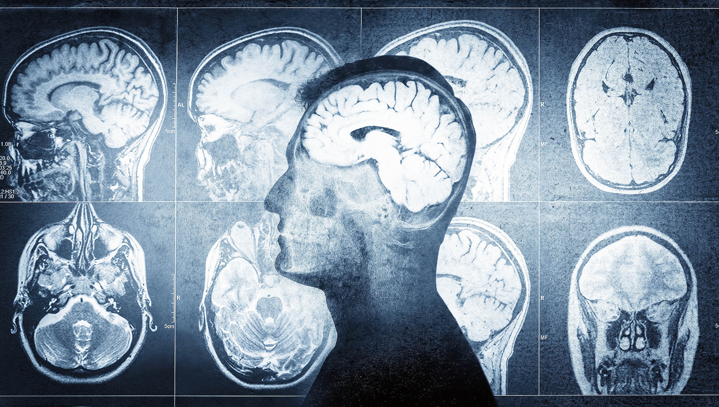 Human brain evolution may explain the rapid rise of autism rates ...