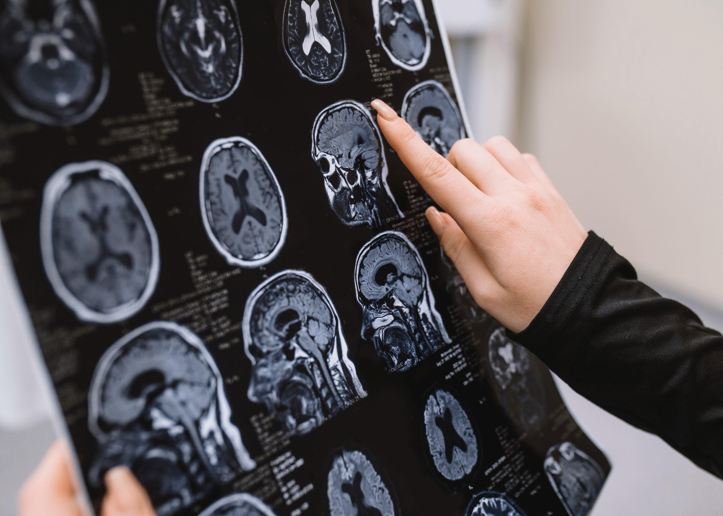 Hidden switches in the brain control genes linked to Alzheimer's ...