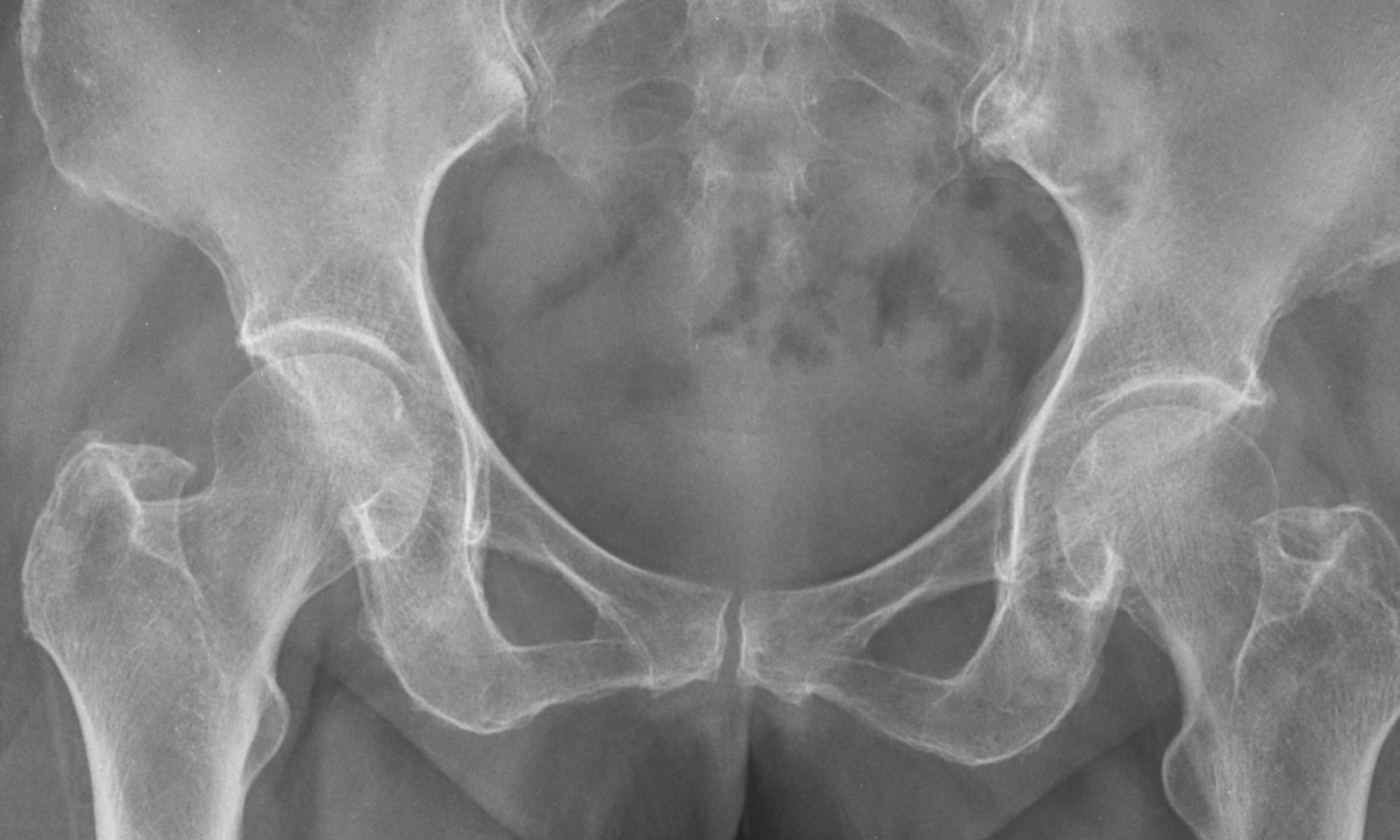 Bone marrow sensor offers new path for osteoporosis therapy - Earth.com